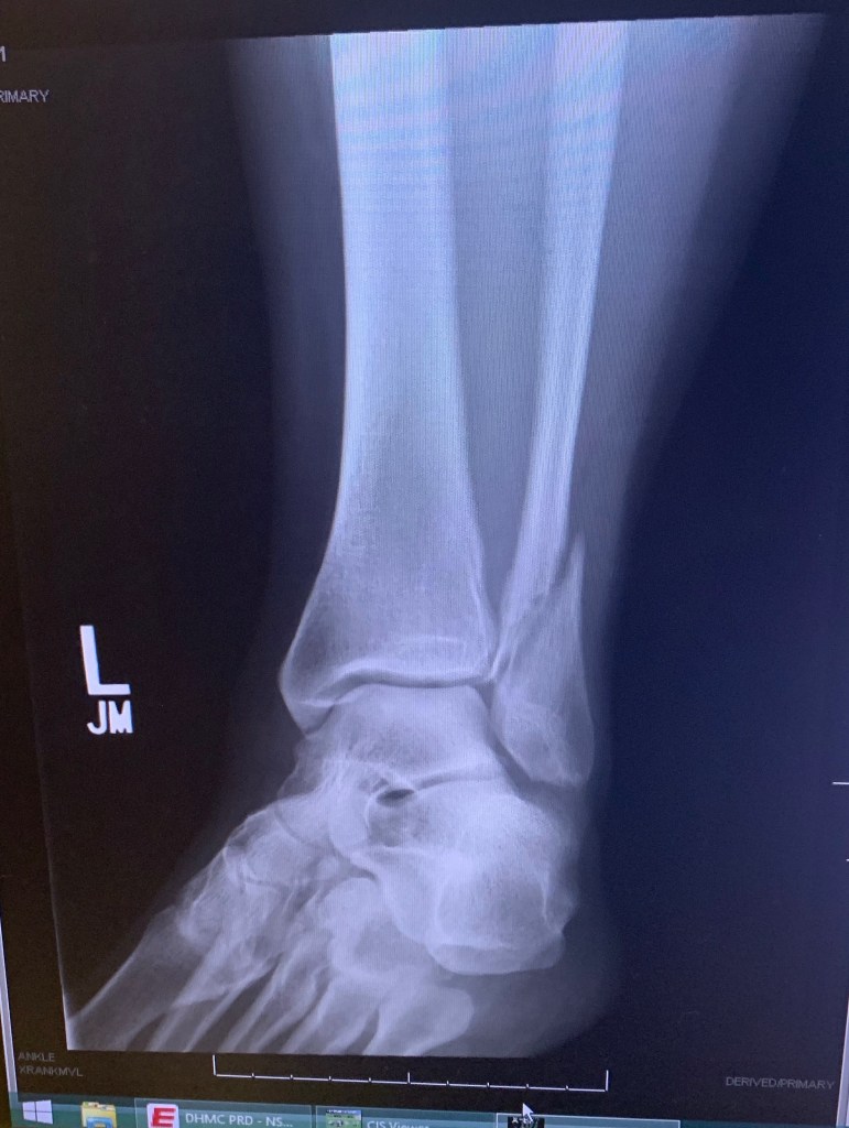 Recovery of a Broken Ankle Part 1: diagnosis and surgery – Colleen ...
