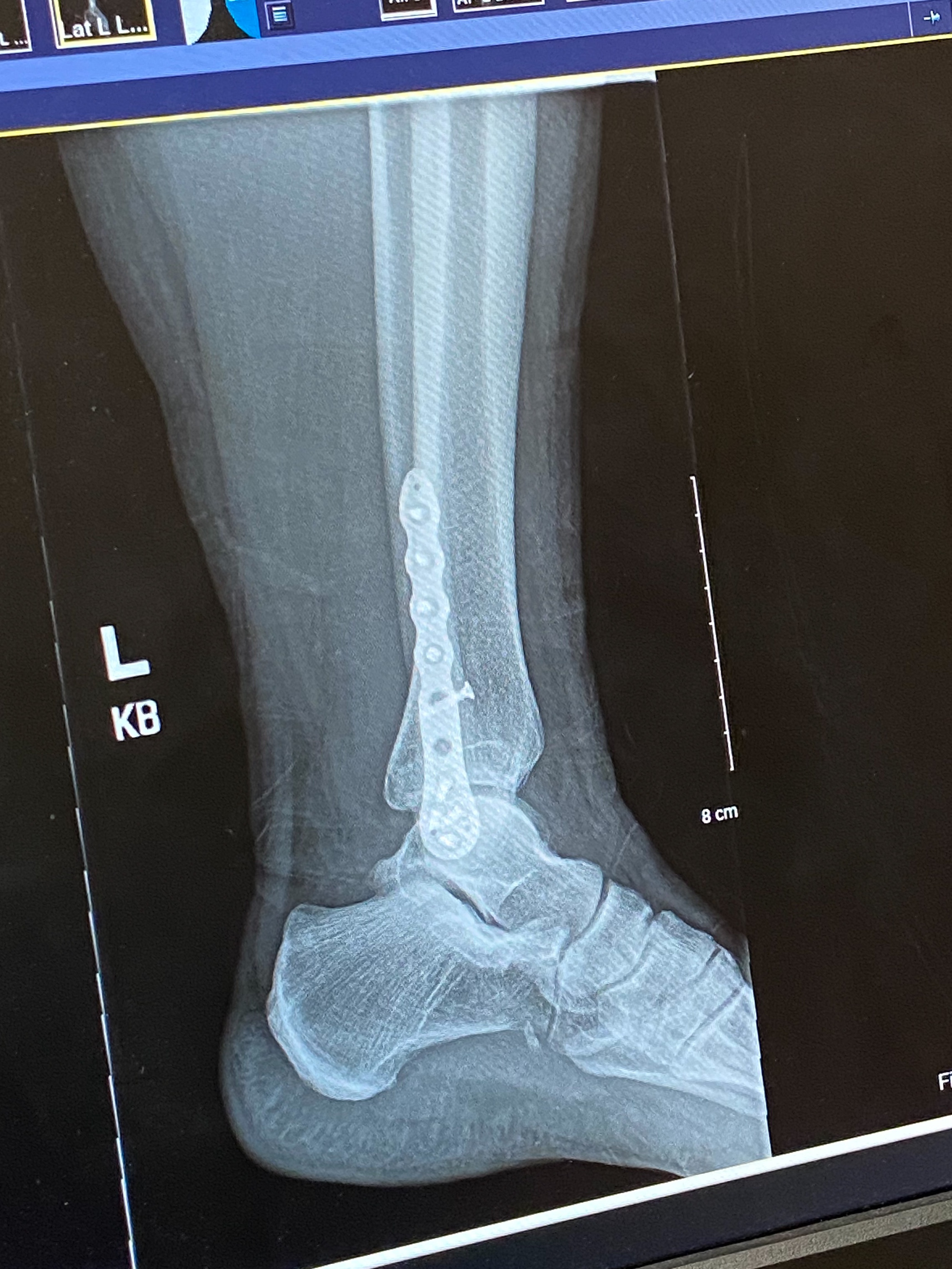 Ankle surgery: part 2 the first 2 weeks post op – Colleen Smith, LMHC, NCC